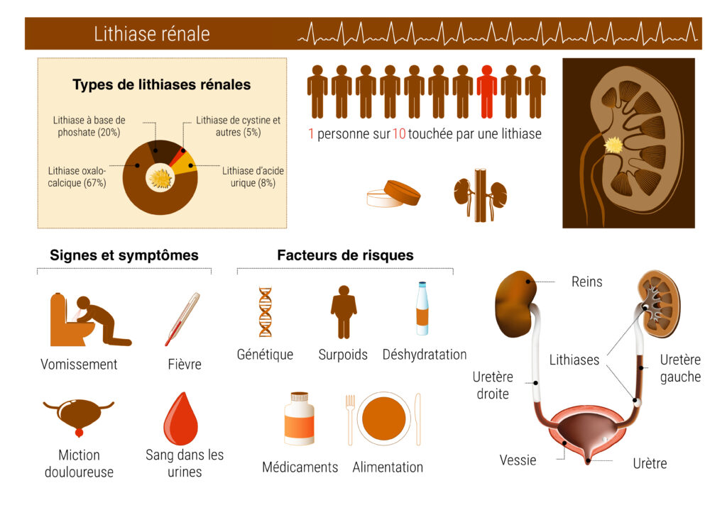Quelles sont les types de lithiases rénales et d’où viennent-elles